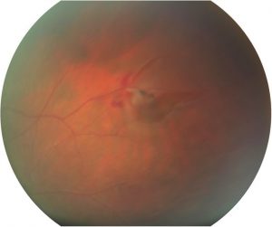 Dr Duprat – Ophtalmologiste Dijon – chirurgie rétine/macula » Maladies